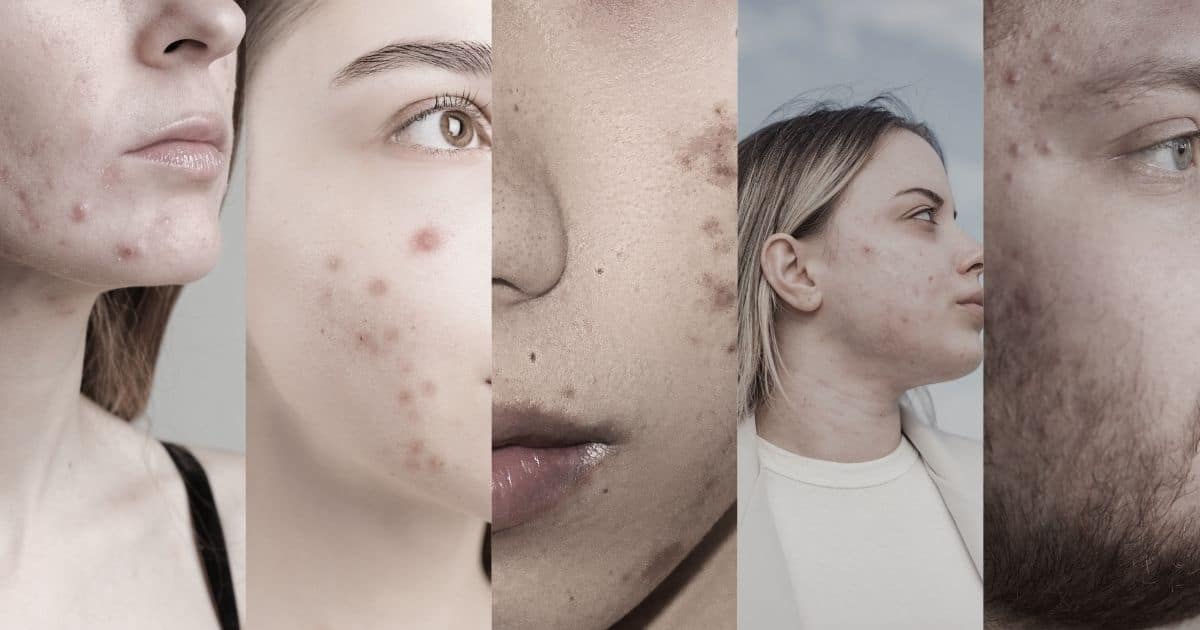 Severe Acne Treatment With Roaccutane (Isotretinoin) - Ashleigh Galea