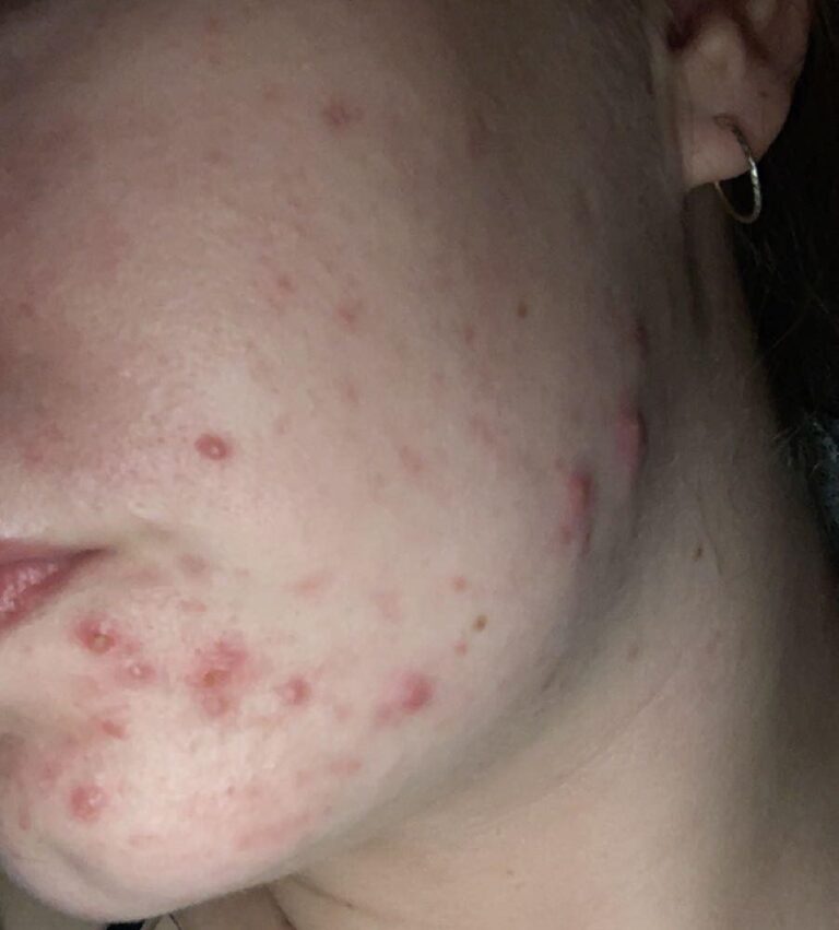 Severe Acne Treatment With Roaccutane (Isotretinoin)
