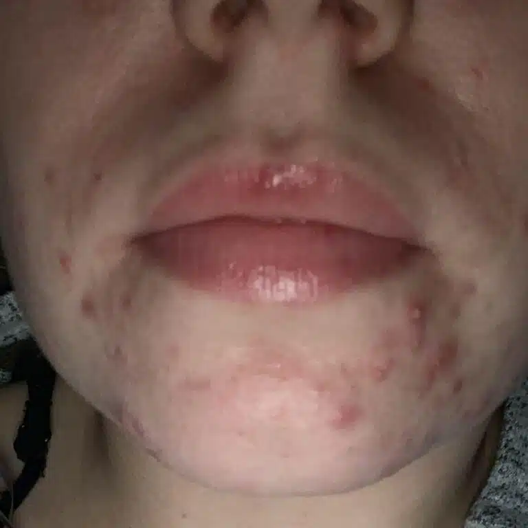 Severe Acne Treatment With Roaccutane (Isotretinoin)